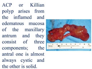 Nasal Polyposis.pptx