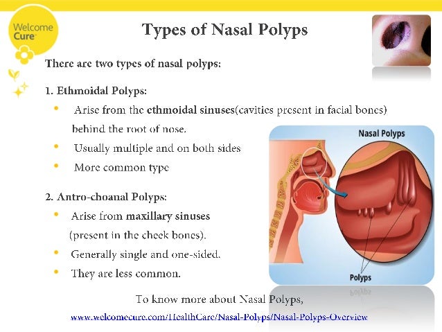 Nasal Polyps What To Know