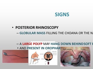 nasalpolyps-151224095805.pptx