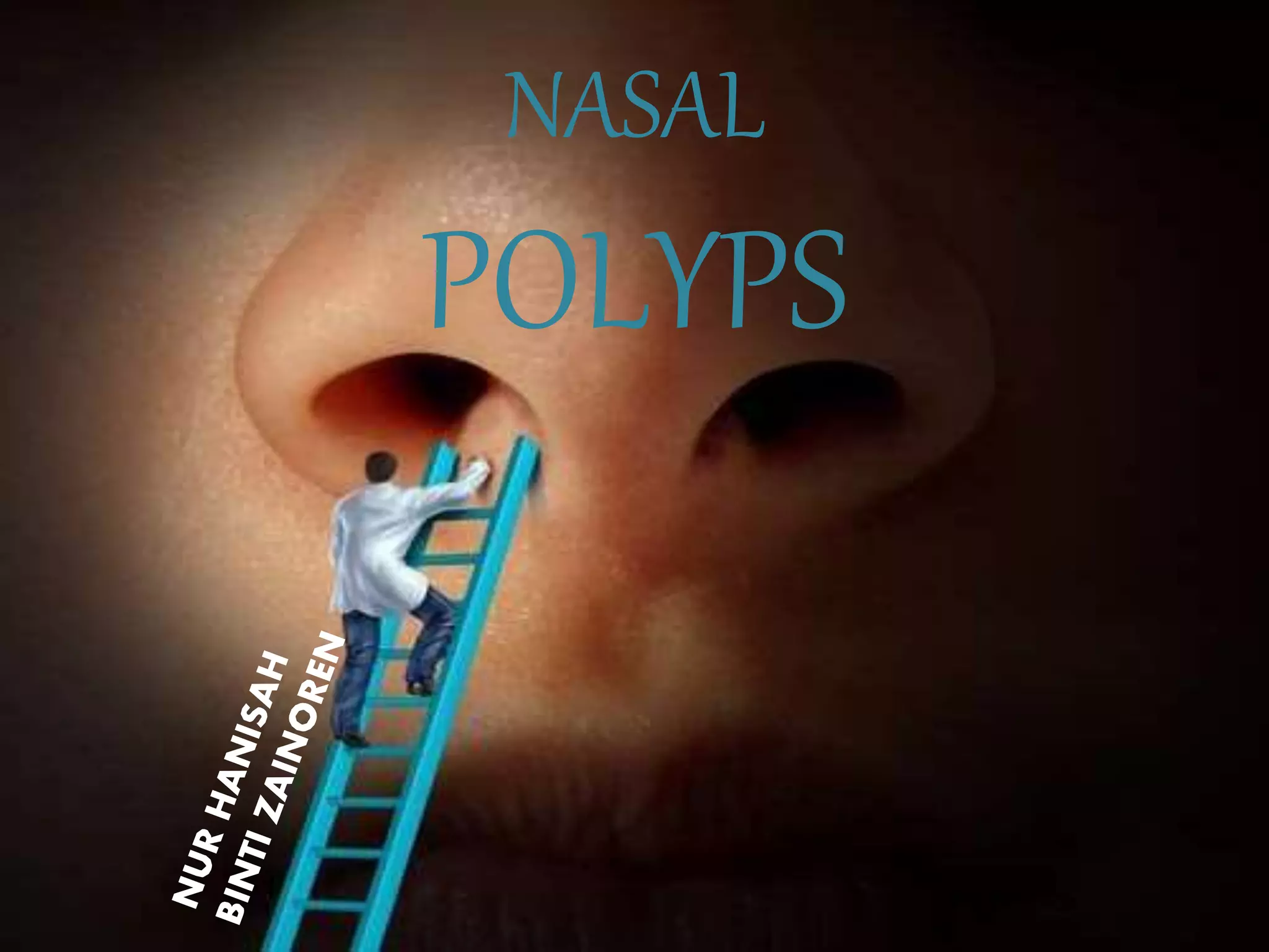 nasalpolyp | PPTX