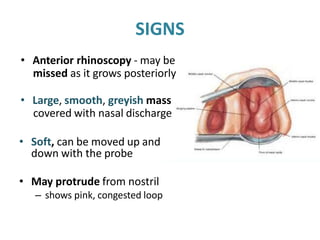 nasalpolyp | PPT