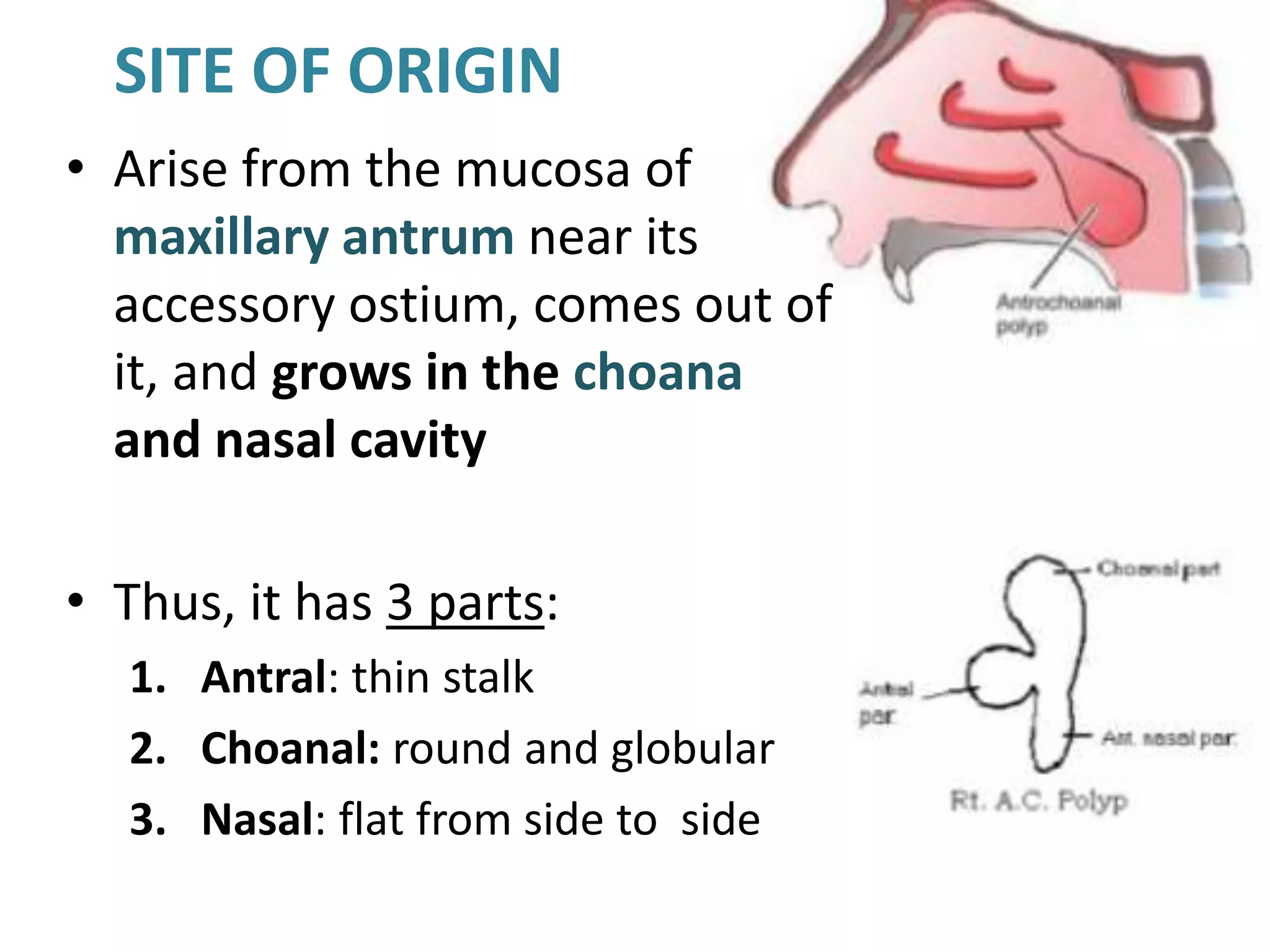 NASAL POLYPS | PPTX