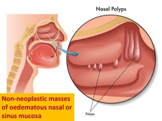 NASAL POLYPS PPT