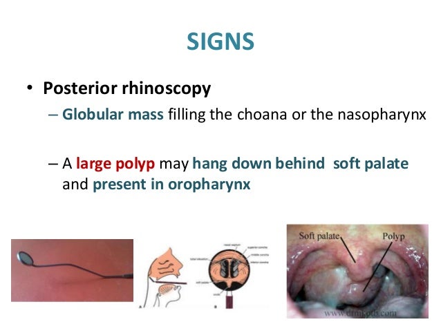 NASAL POLYPS
