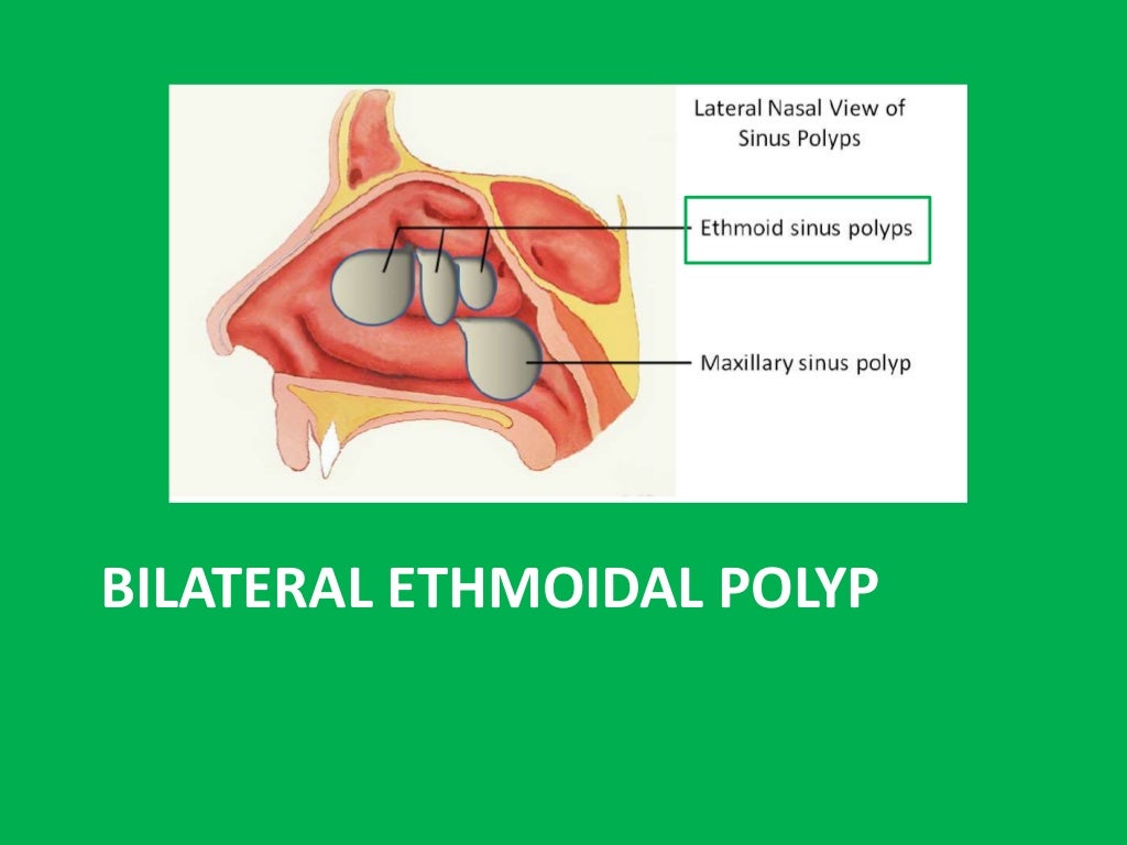 NASAL POLYPS