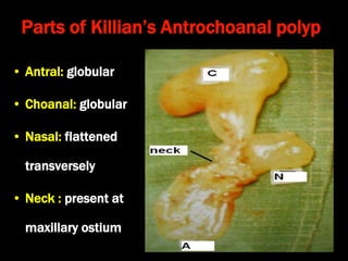 Nasal polyps | PPT