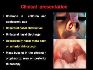 Nasal polyps | PPT