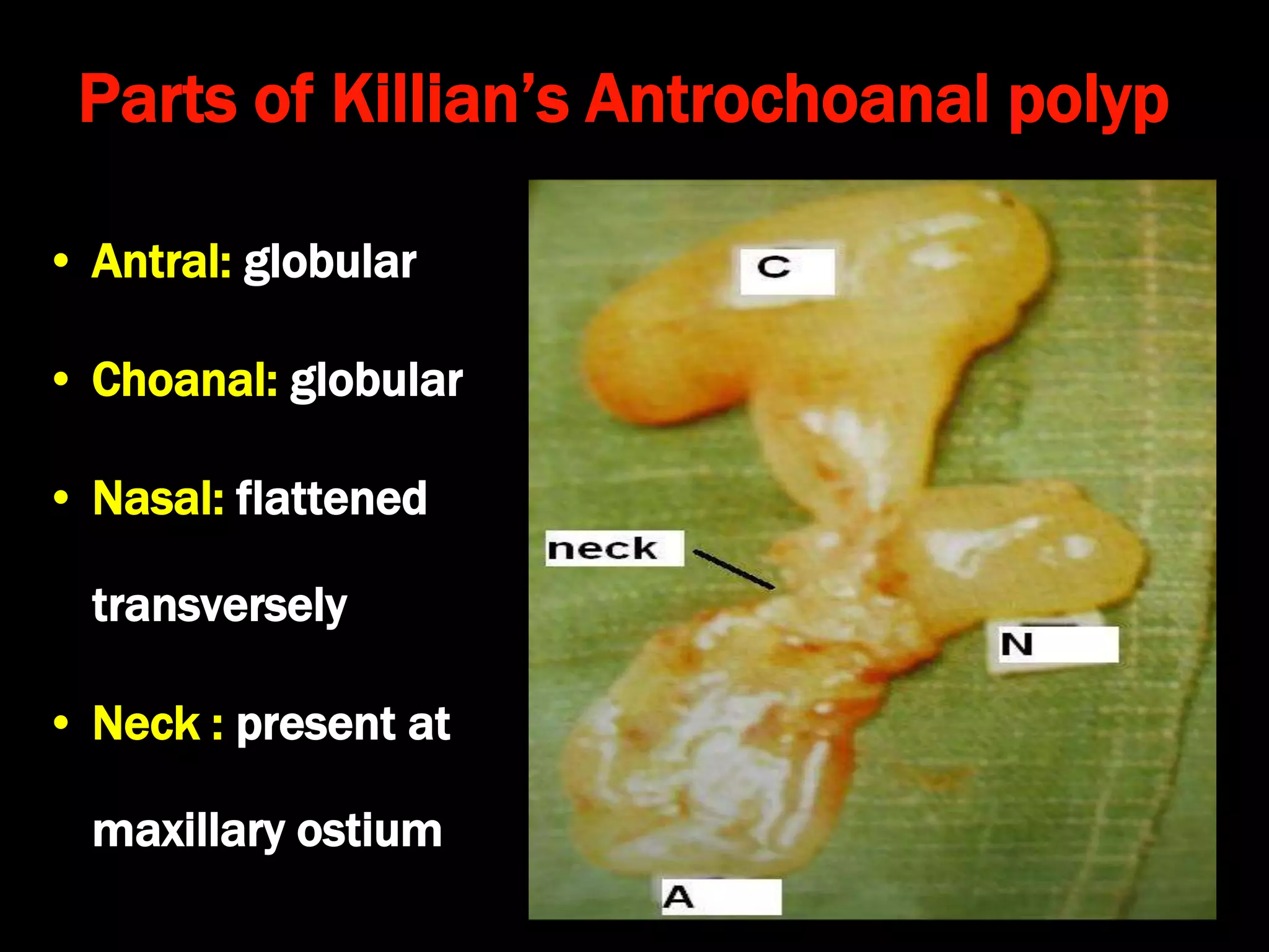 Nasal polyps | PPT