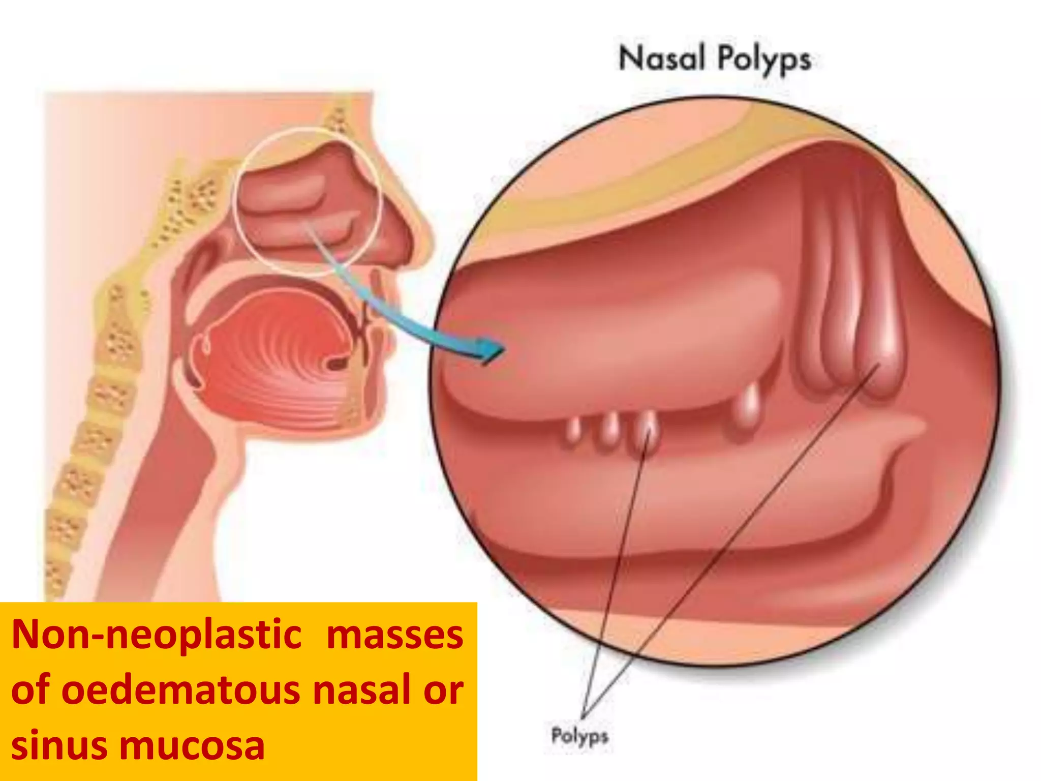 nasalpolyps.pptx