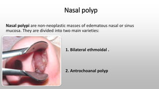 nasal polyps | PPTX