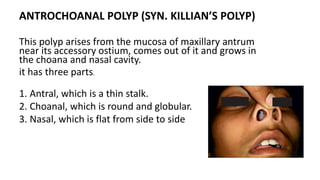 nasal polyps | PPTX | Ear, Nose and Throat Conditions | Diseases and ...
