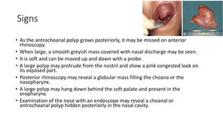 nasal polyps | PPTX | Ear, Nose and Throat Conditions | Diseases and ...