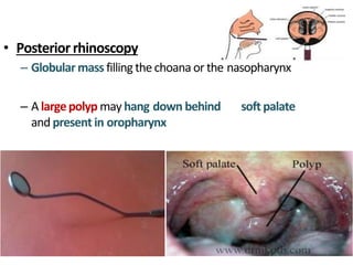 Nasalpolyps | PPTX
