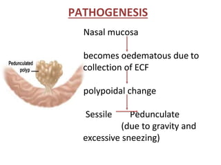 Nasalpolyps | PPTX