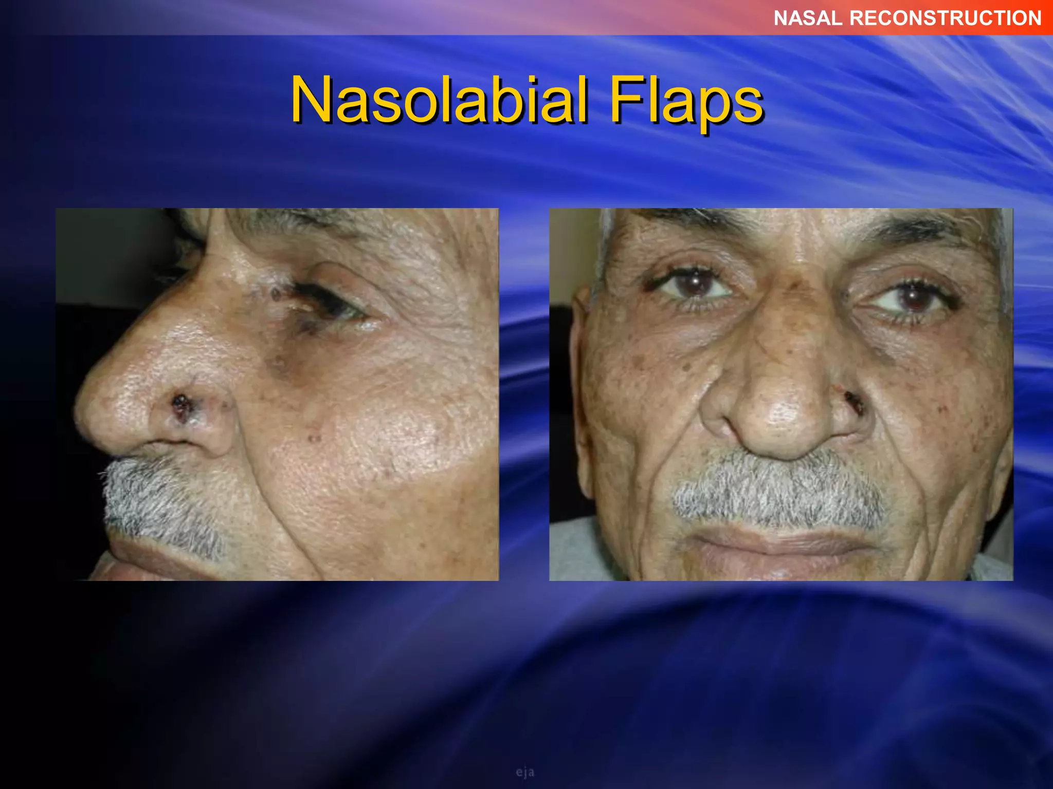 NASAL RECONSTRUCTION BY HUSSEIN ABULHASSAN | PPT