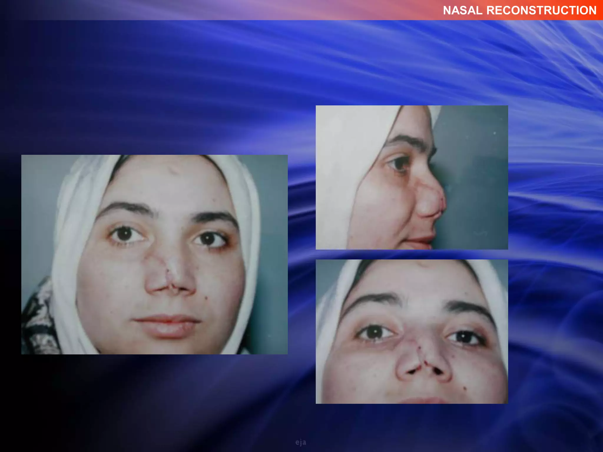 NASAL RECONSTRUCTION BY HUSSEIN ABULHASSAN | PPT