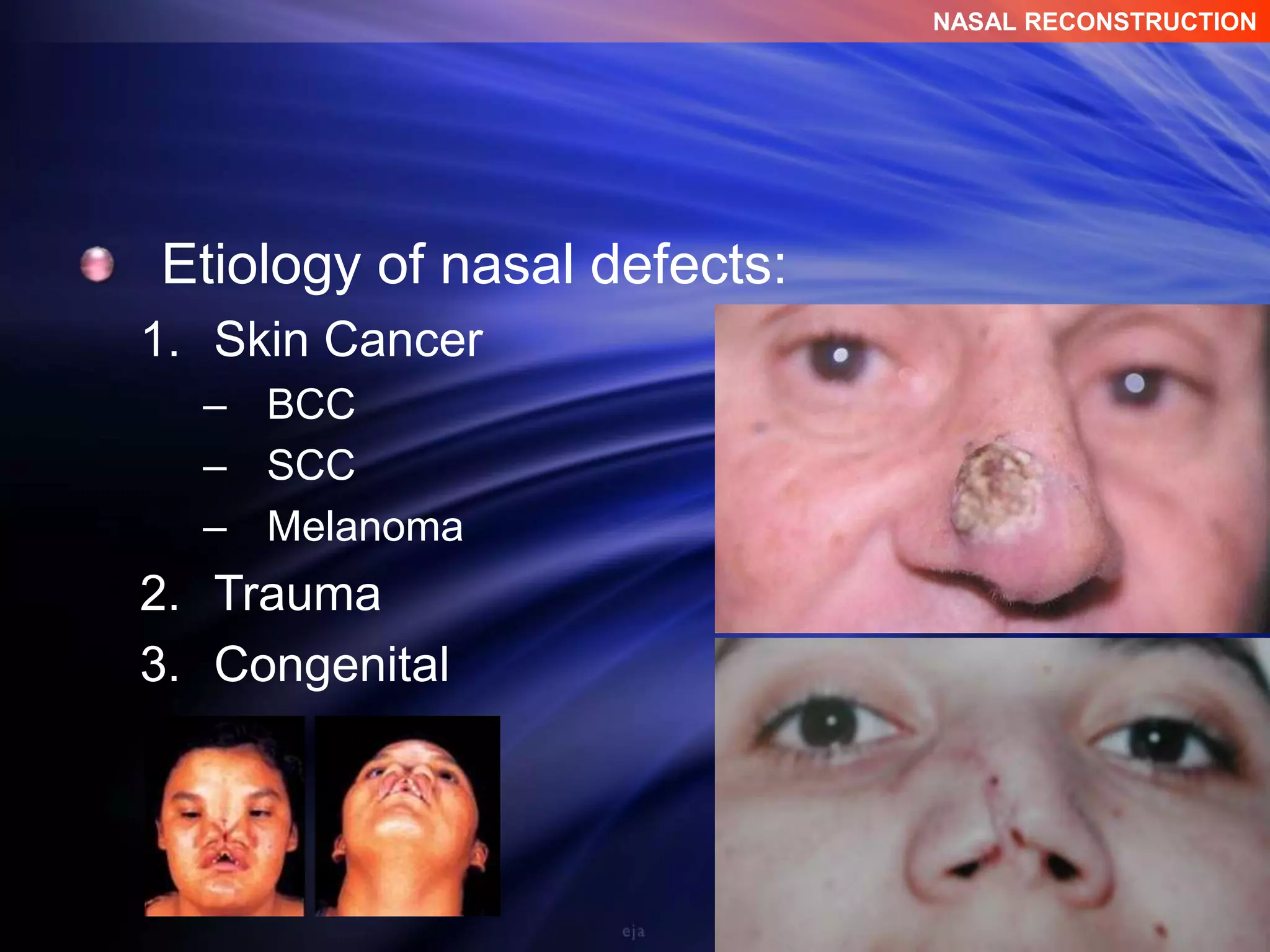 NASAL RECONSTRUCTION BY HUSSEIN ABULHASSAN | PPT