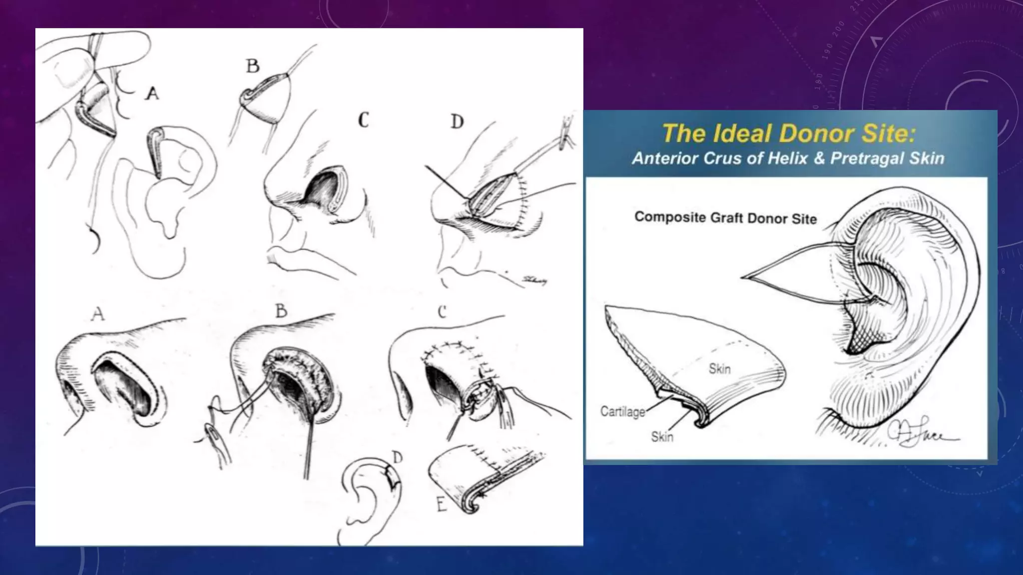 Nasal Reconstruction, Dr Sheraz.pptx