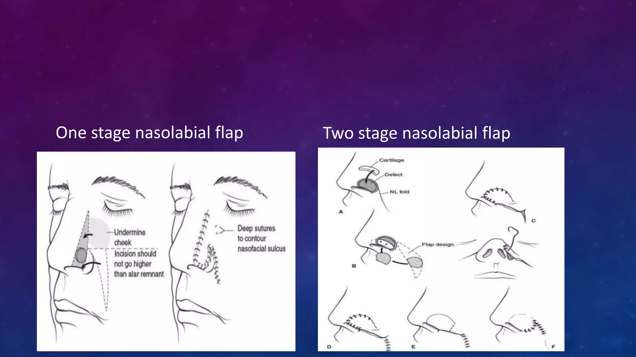 Nasal Reconstruction, Dr Sheraz.pptx