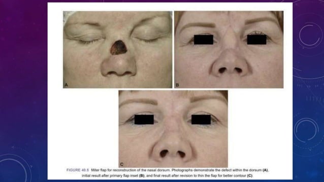 Nasal Reconstruction, Dr Sheraz.pptx
