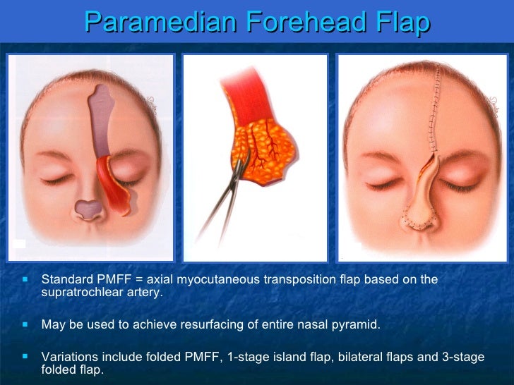 Nasalreconstructiongrandrounds043009