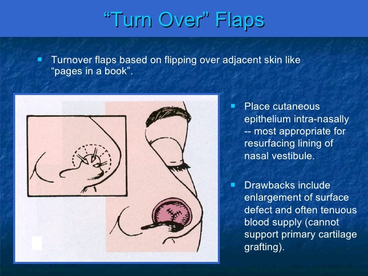 Nasalreconstructiongrandrounds043009