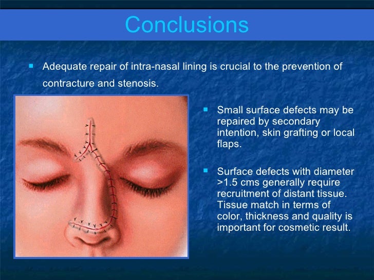 Nasalreconstructiongrandrounds043009