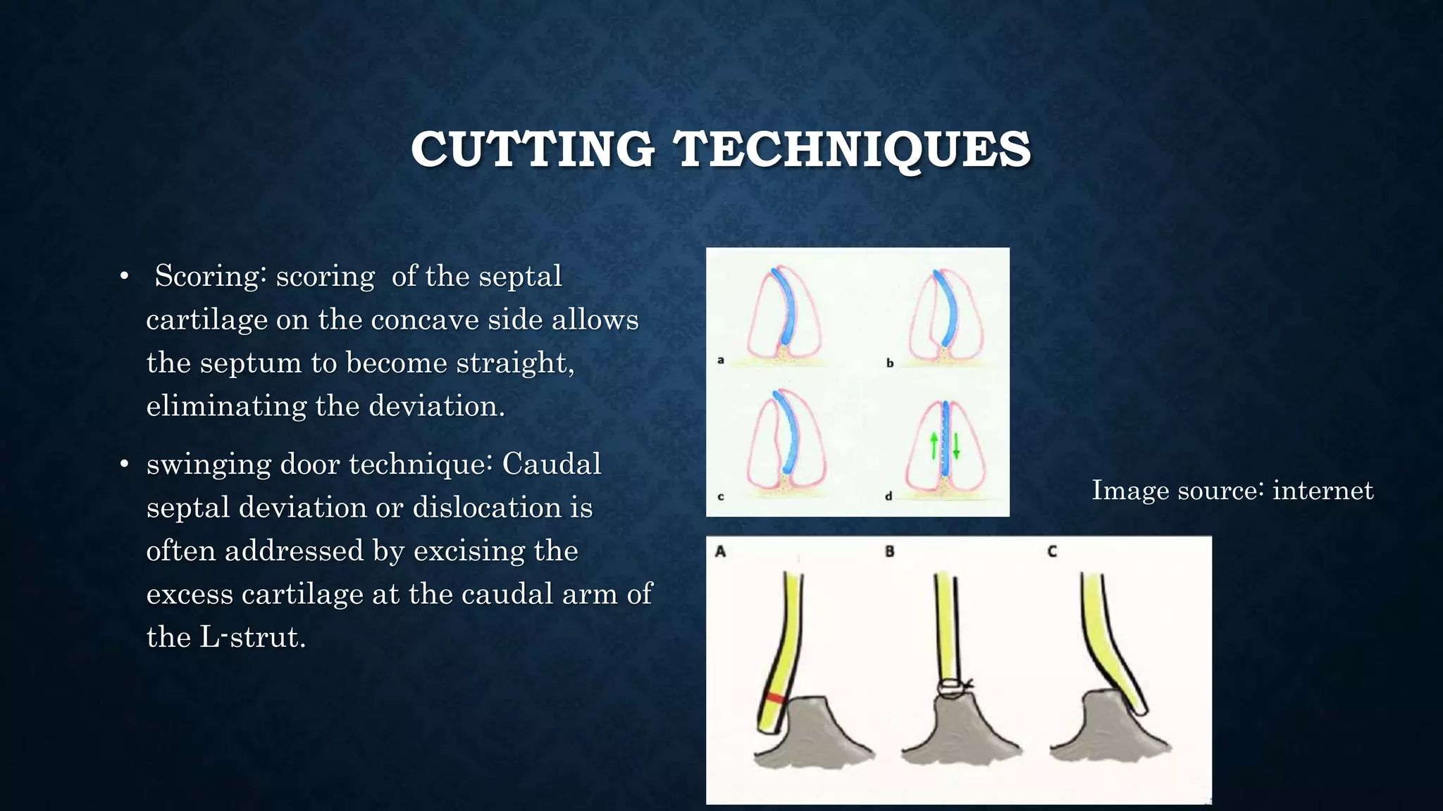 Nasal septal anatomy and septoplasty | PPTX