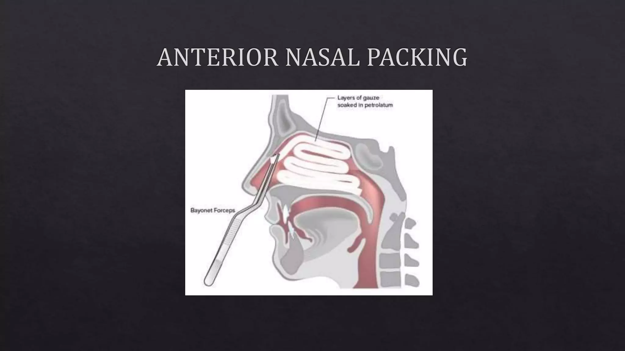 Nasal septal fractures | PPTX