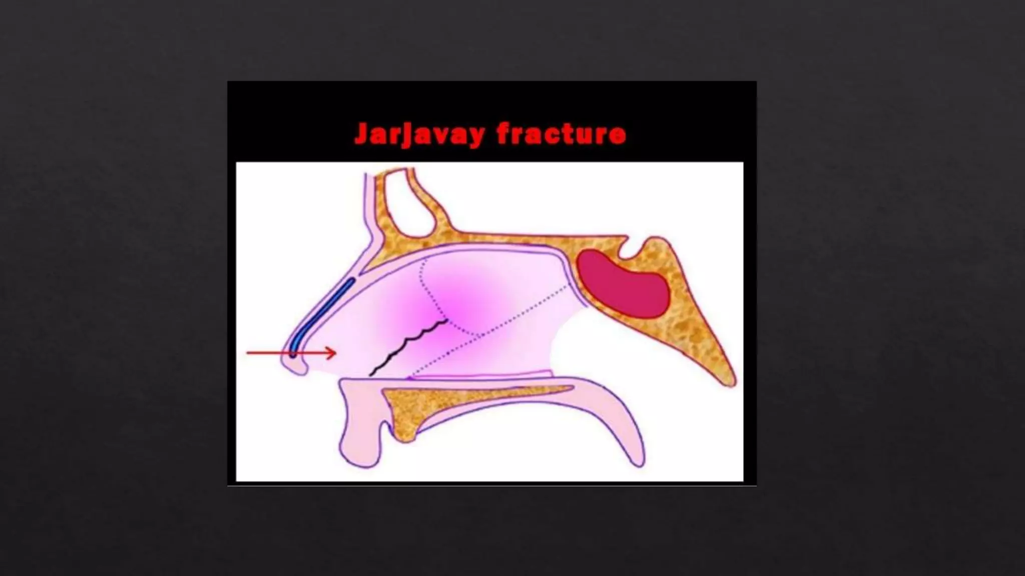 Nasal septal fractures | PPTX