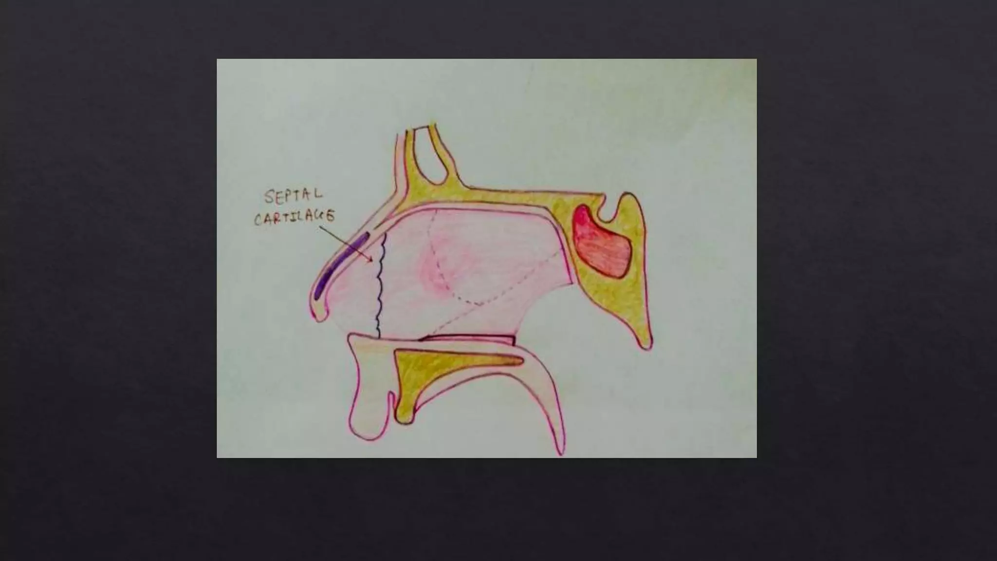 Nasal septal fractures | PPTX