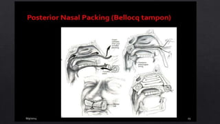 Nasal septal fractures | PPTX