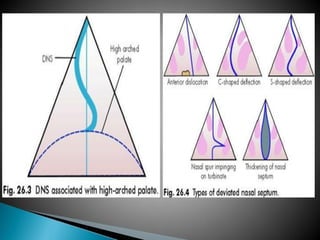 2 Nasal Septum Anatomy, DNS, Surgery by RA Ritesh.pptx