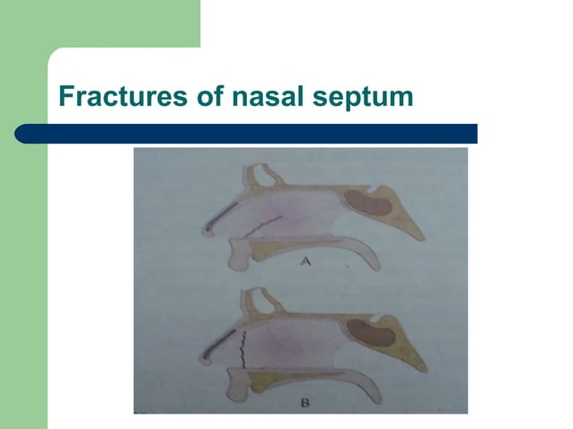 Nasal septum and its diseases | PPT | Death, Injury, or Military ...