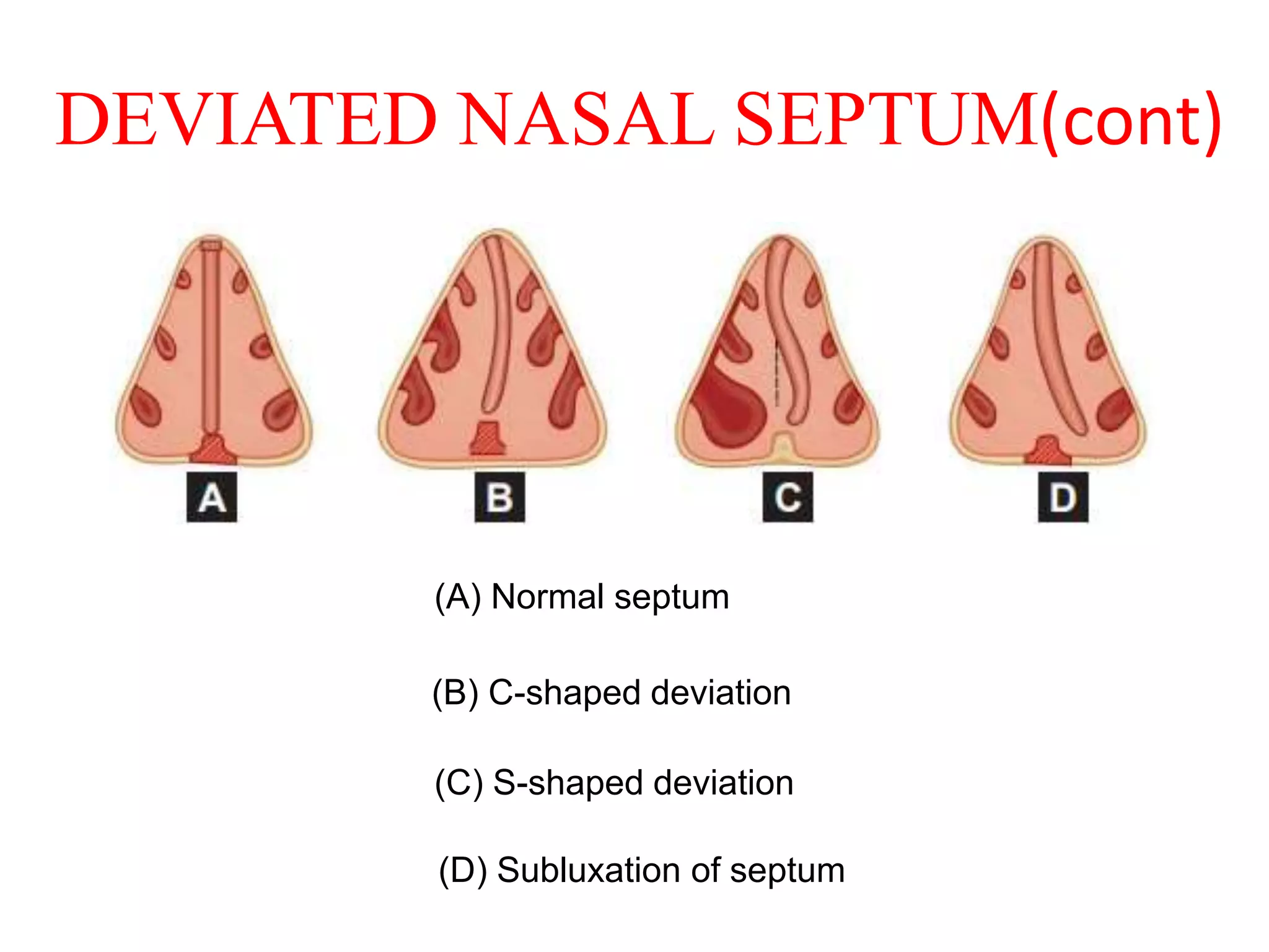 Nasal Septum and its Diseases | PPT