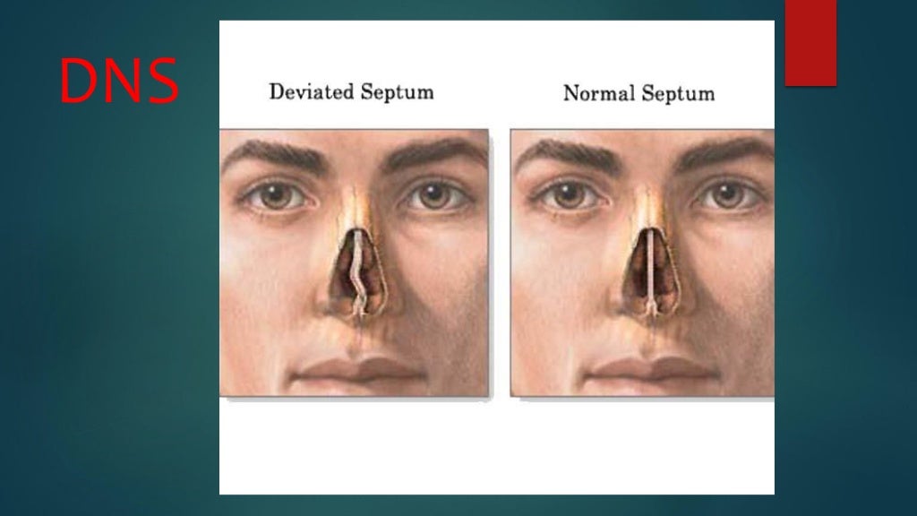 Nasal septum & its diseases