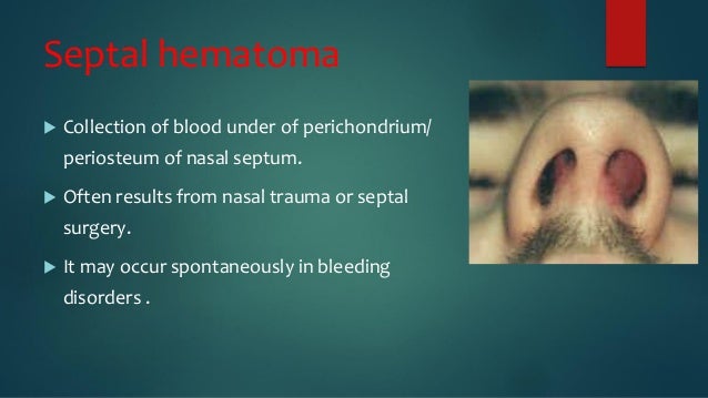 Nasal septum & its diseases