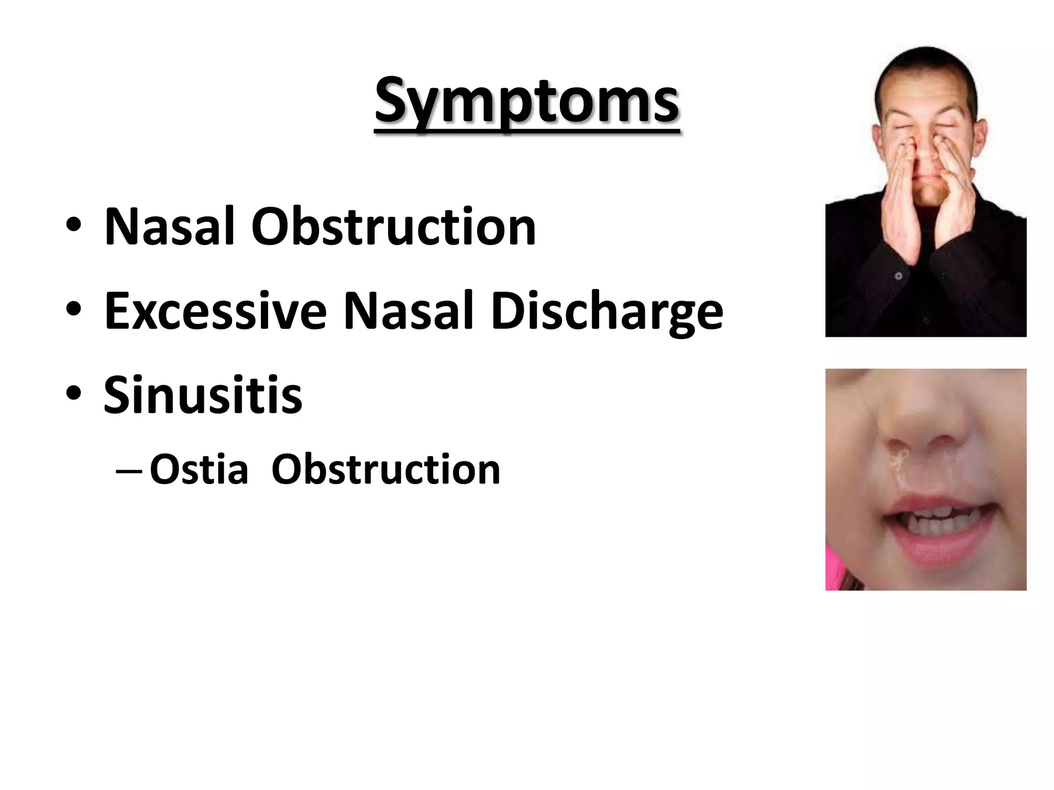 Nasal synechia | PPTX