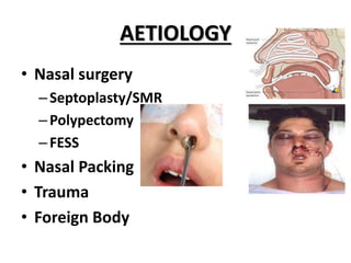 Nasal synechia | PPTX