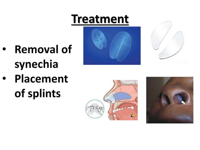 Nasal synechia | PPTX