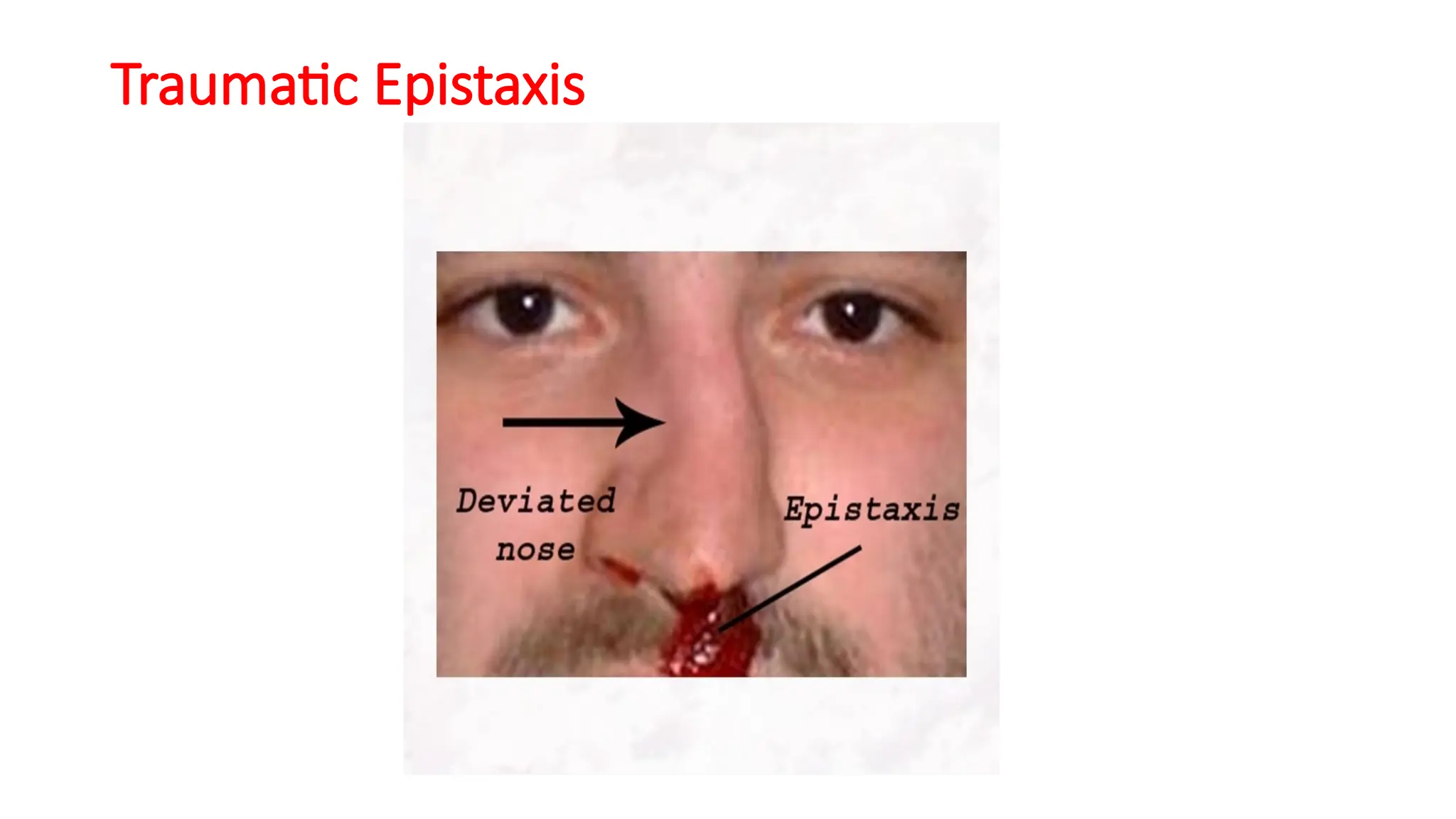 Nasal trauma, septal hematoma and nasal abscess..pptx