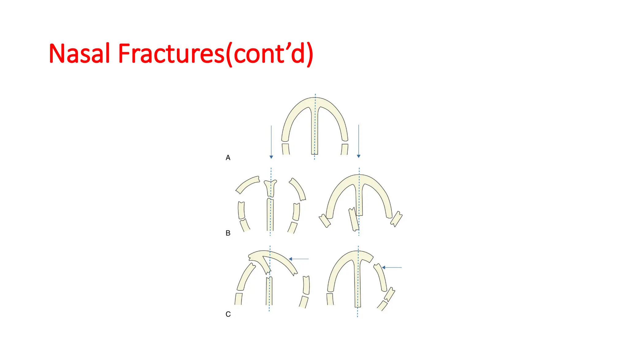 Nasal trauma, septal hematoma and nasal abscess..pptx