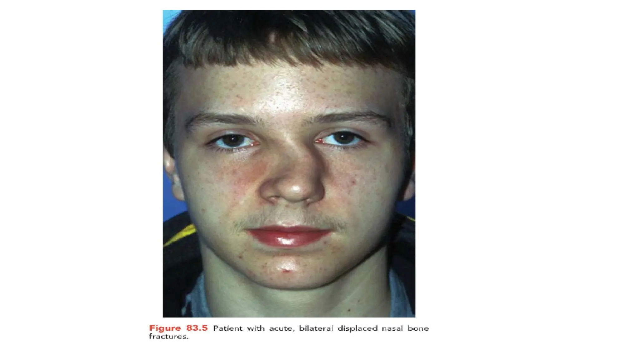 Nasal trauma, septal hematoma and nasal abscess..pptx