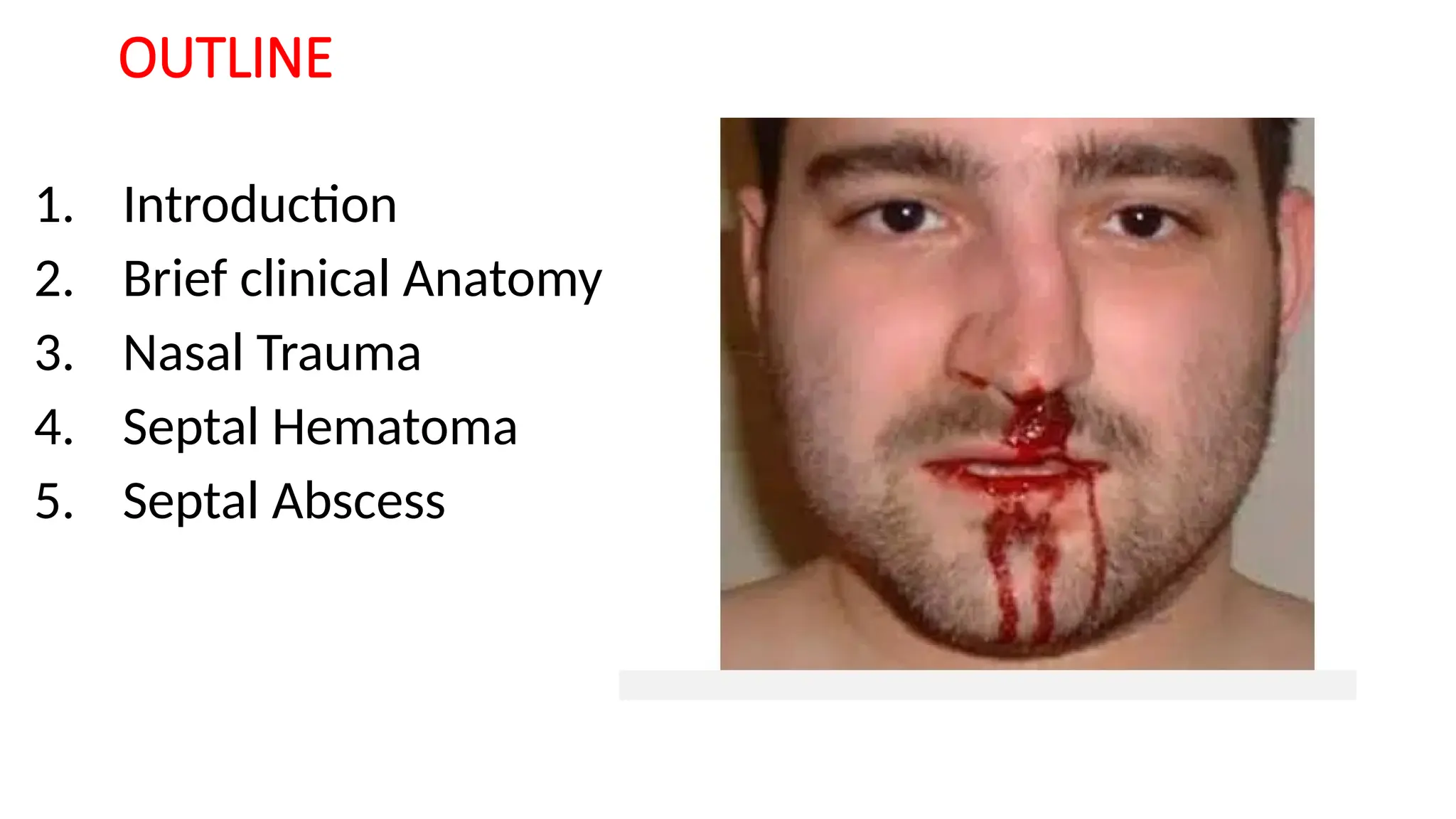 Nasal trauma, septal hematoma and nasal abscess..pptx