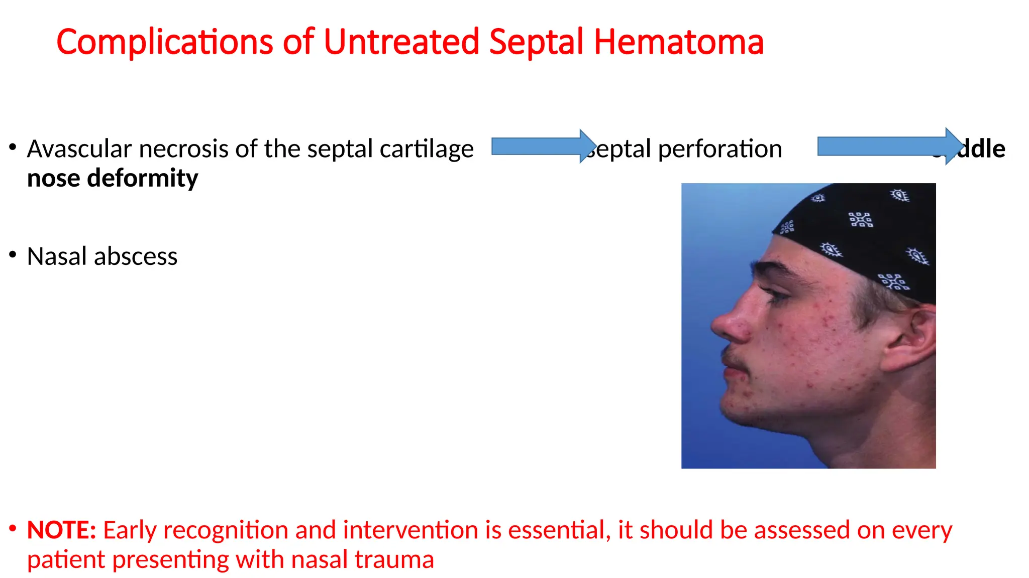 Nasal trauma, septal hematoma and nasal abscess..pptx