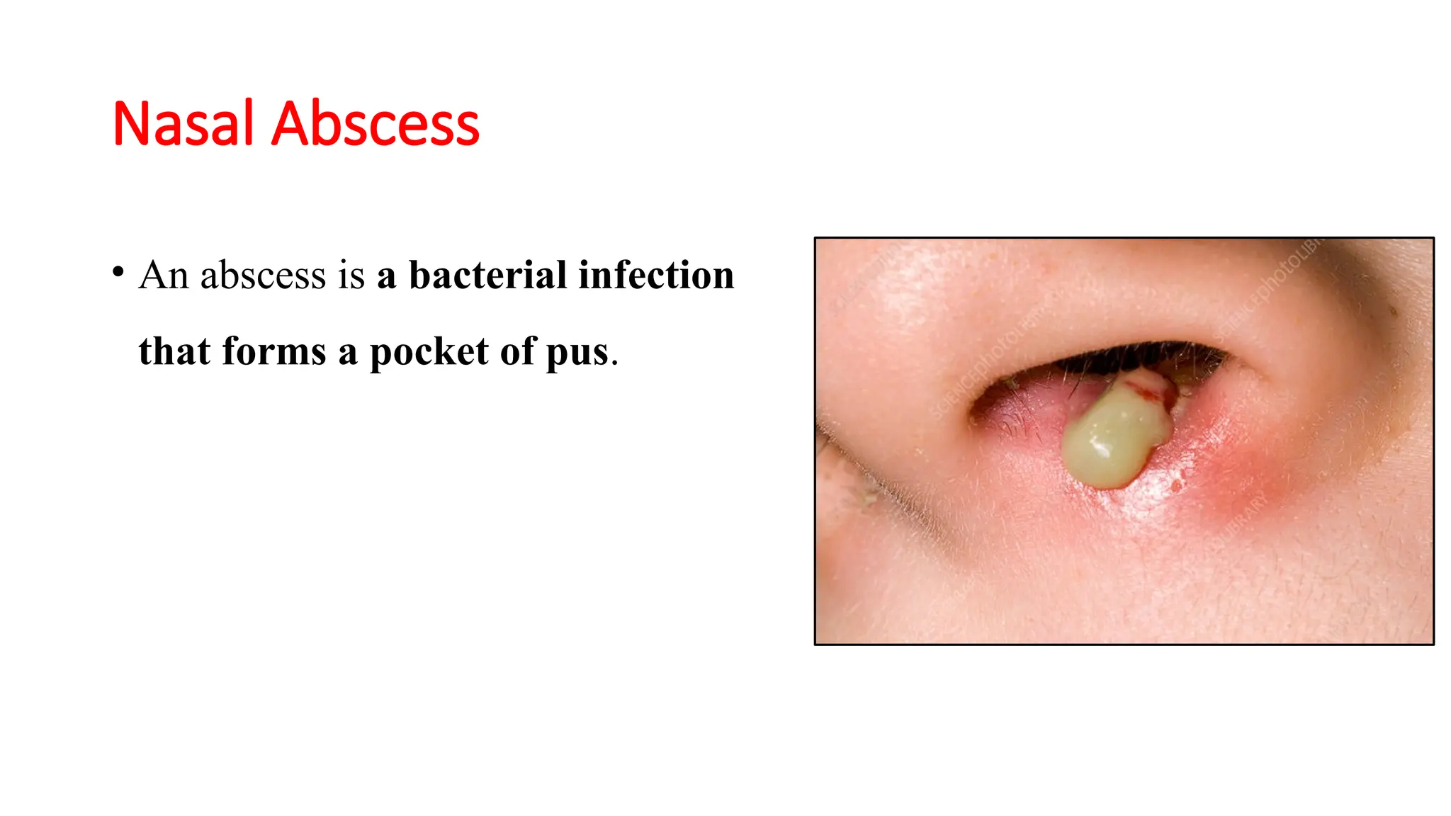 Nasal trauma, septal hematoma and nasal abscess..pptx