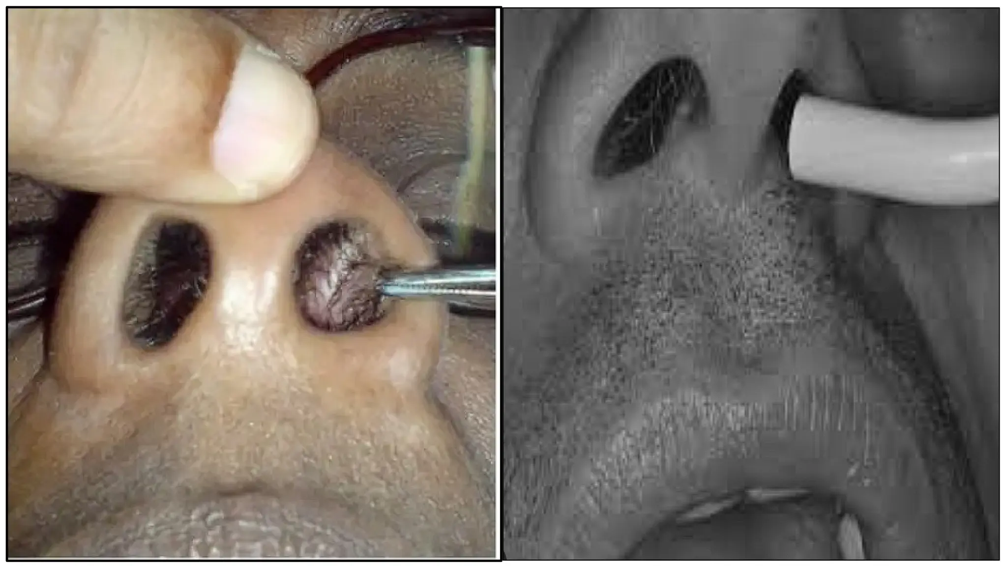 Nasal trauma, septal hematoma and nasal abscess..pptx