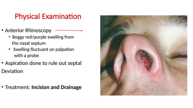 Nasal trauma, septal hematoma and nasal abscess..pptx