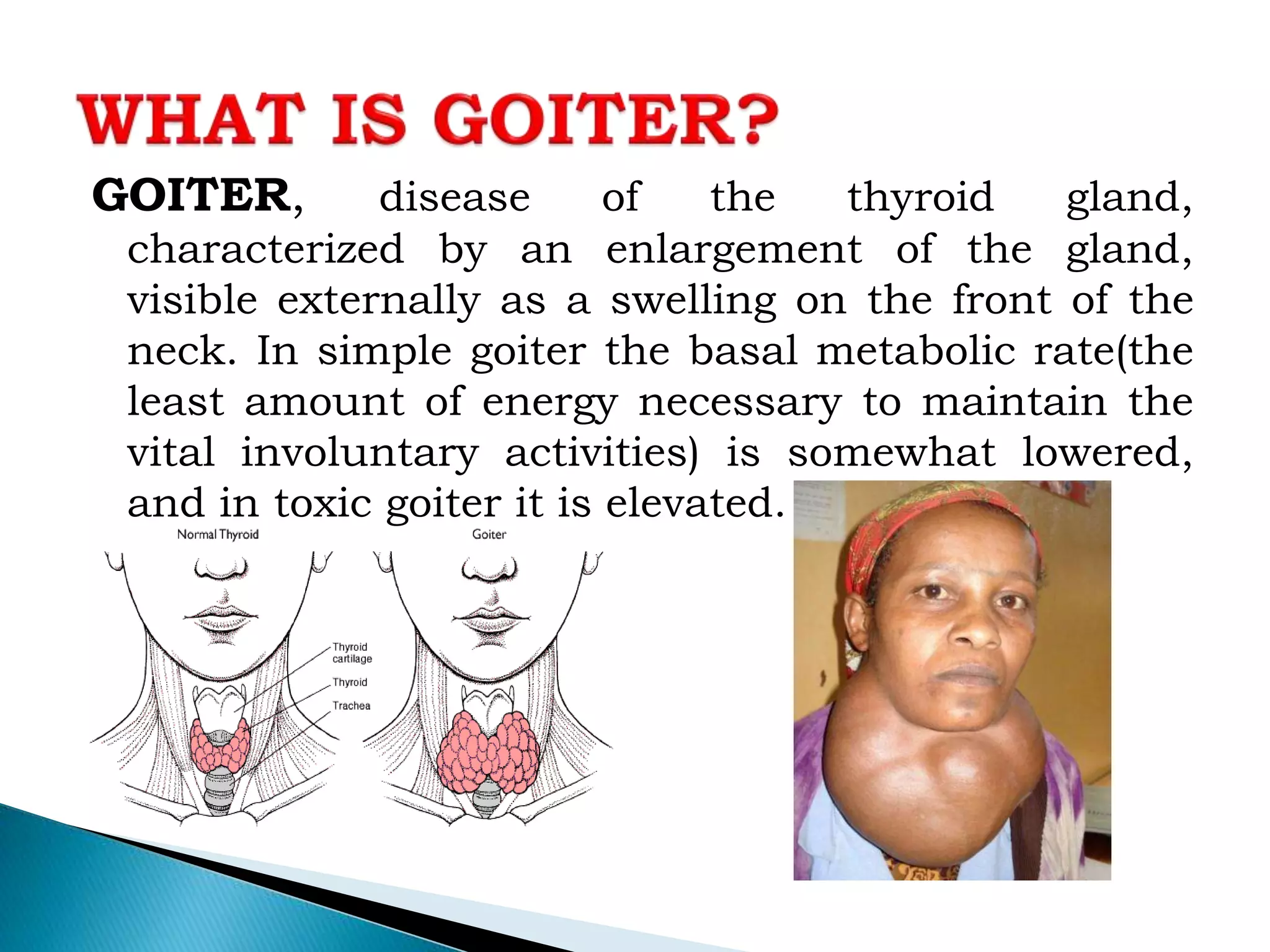 GOITER (DISEASE OF THYRIOD GLAND) | PPTX