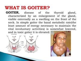 GOITER (DISEASE OF THYRIOD GLAND) | PPTX